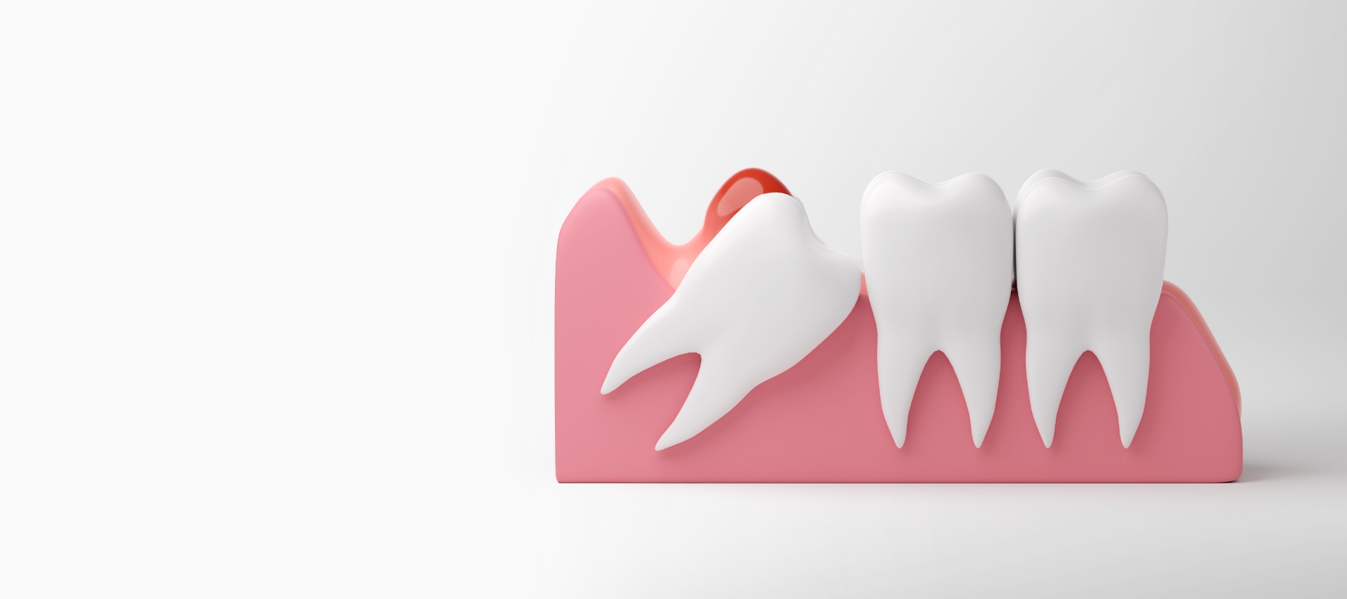 Third Molar Extractions in Shelby Township, MI | Macomb Oral and ...